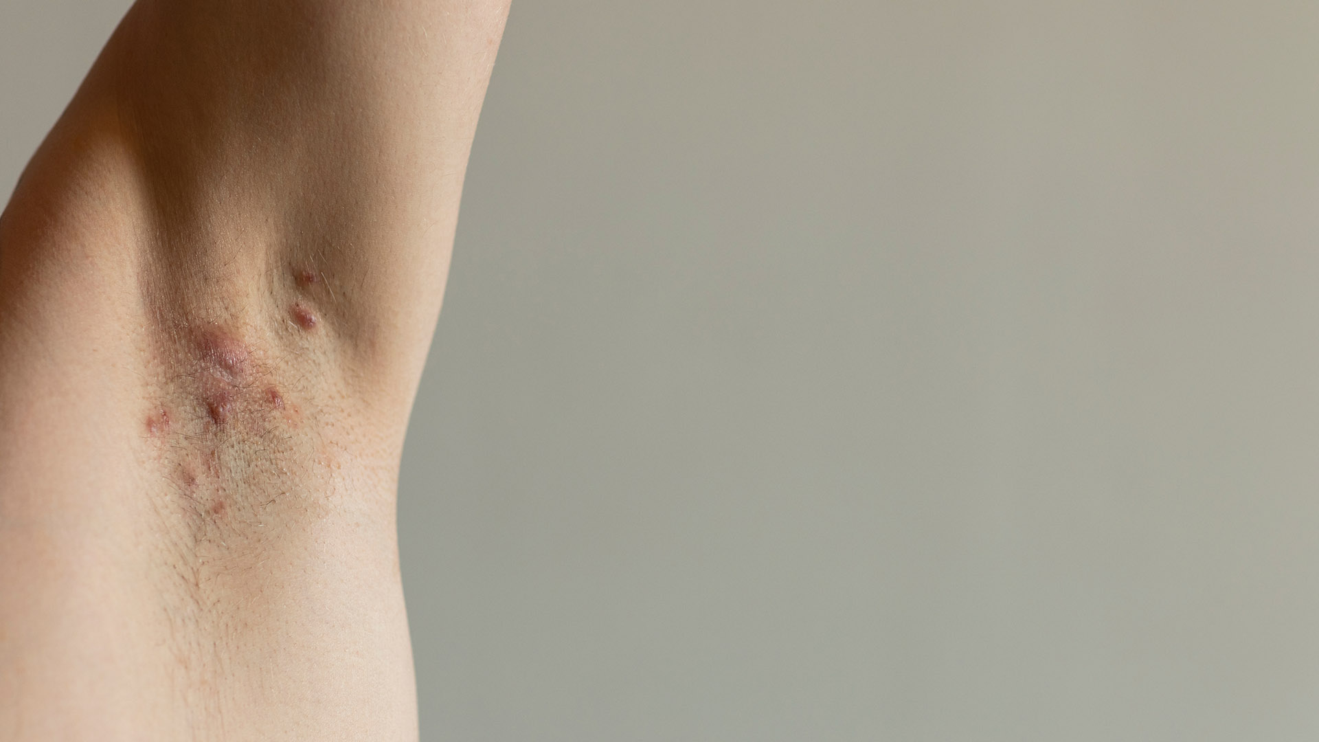 Akne inversa: Ursachen, Symptome, Therapie | gesund.bund.de